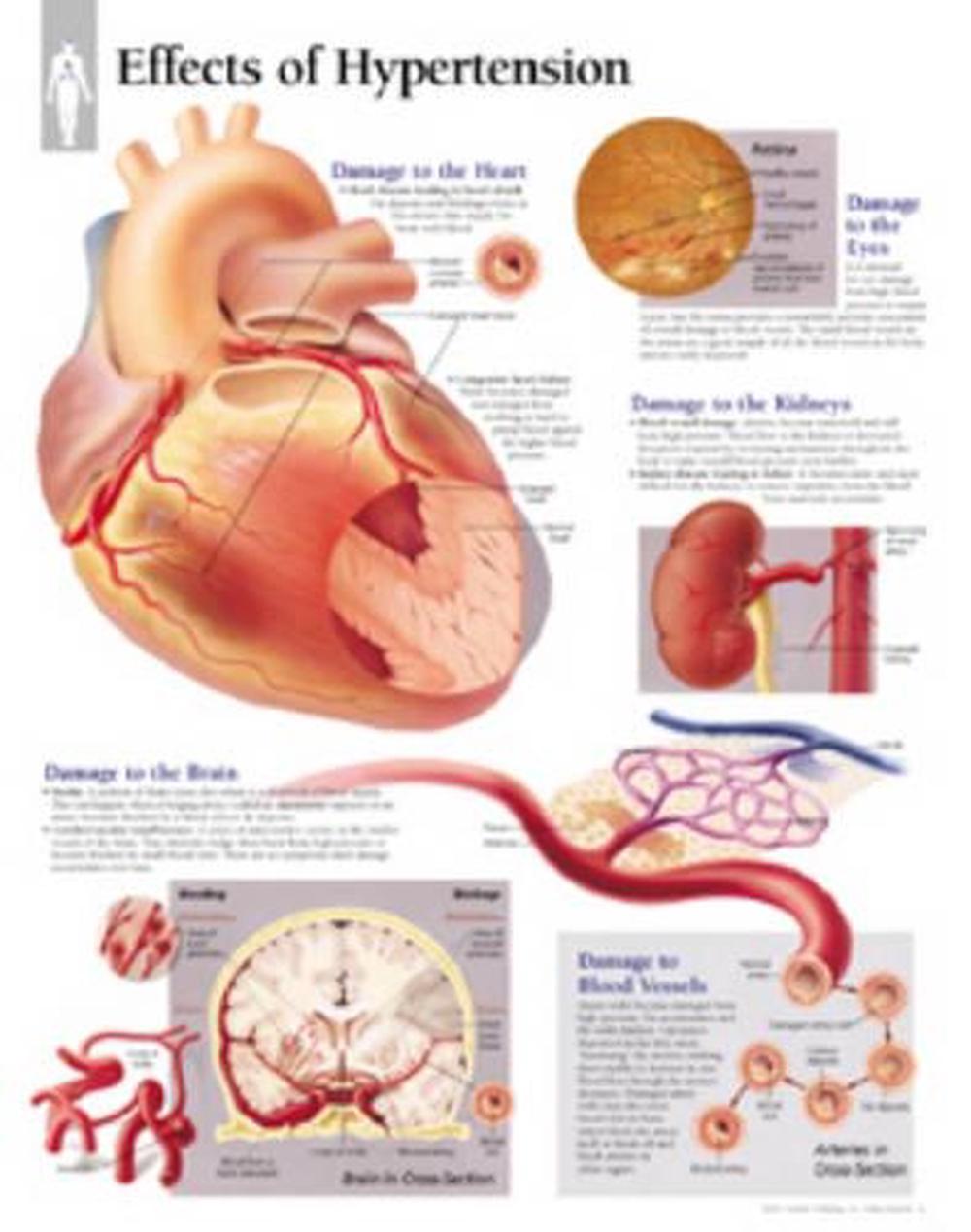 Effects Of Hypertension Laminated Poster By Scientific Publishing Effects Of Hypertension Laminated Poster By Scientific Publishing